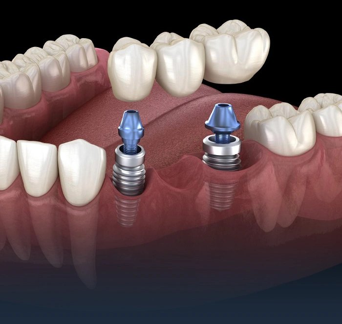 Single Tooth Implants & Multi-Tooth Bridges at Texas Dental Implant ...